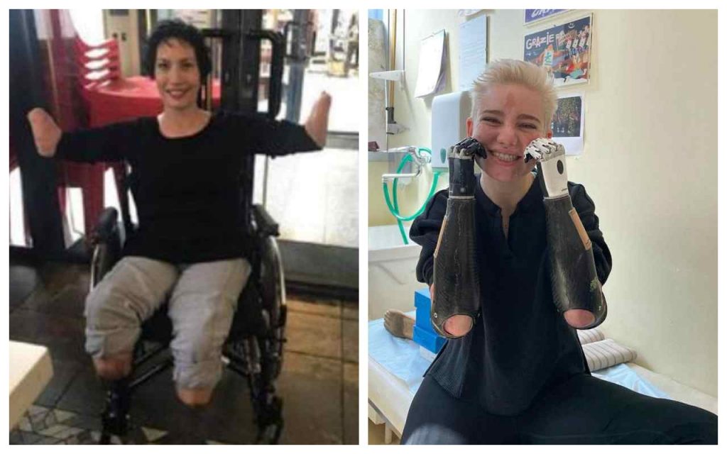 Le amputano braccia e gambe per "errore" | L'odissea di Anna e l'aiuto ...